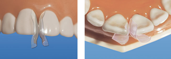 Bow Anterior Matrices. TOR VM